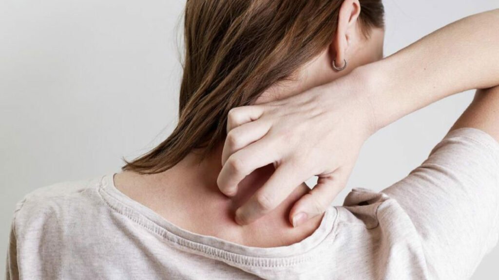 Bukan Hanya Panu, Ini Penyebab Bercak Putih pada Kulit - Berita Seleb ...